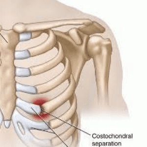 What is Costochondral Separation? | Causes | Symptoms | Treatment ...